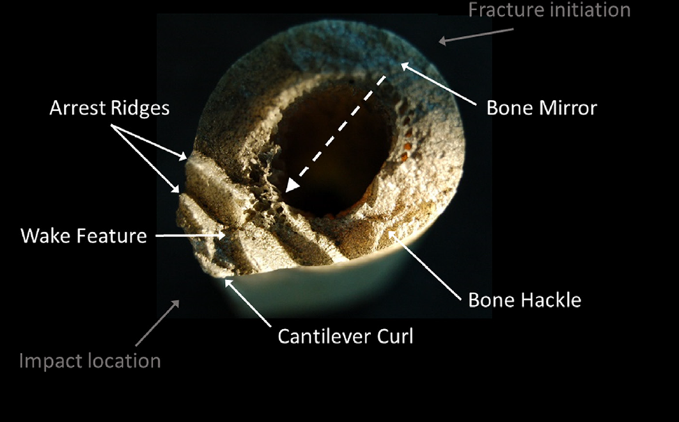 Understanding Butterfly Fractures | Health Science Reviews